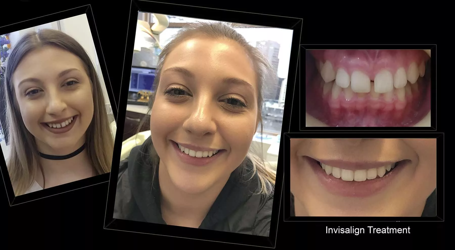 White Spots on Teeth and Enamel Defect Treatment Melbourne