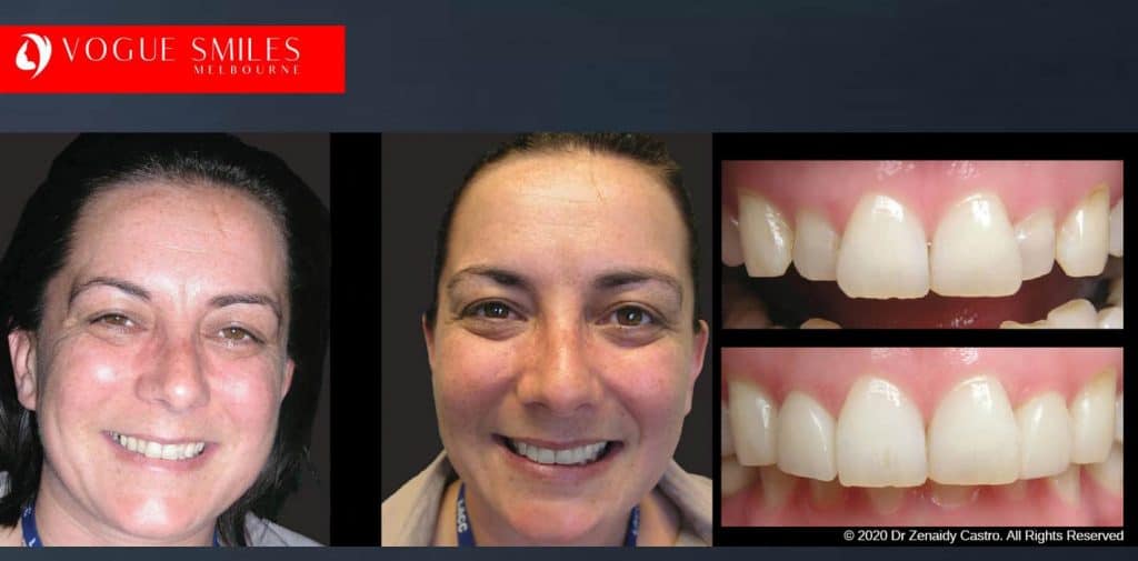 Straighten Overlapping, Crooked, Crowded teeth in Melbourne