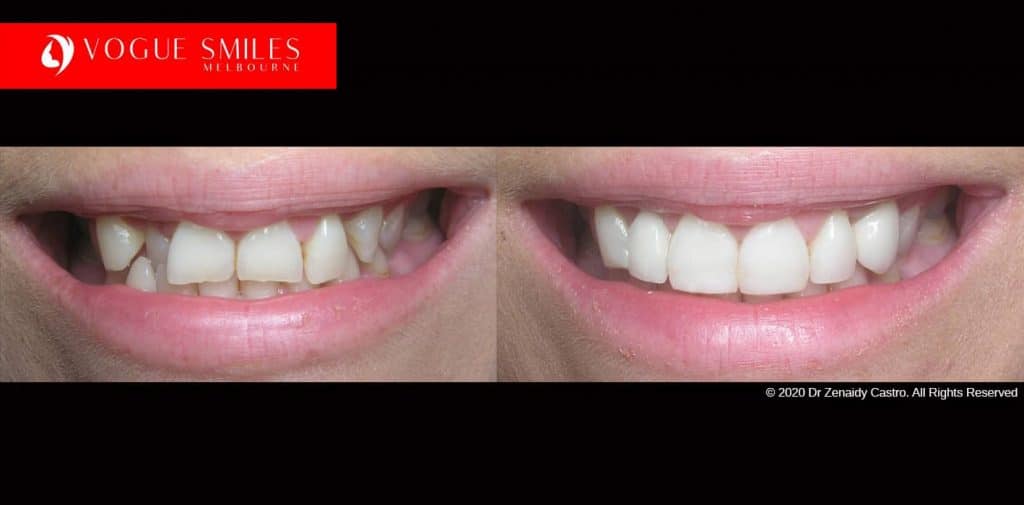 Straighten Overlapping, Crooked, Crowded teeth in Melbourne