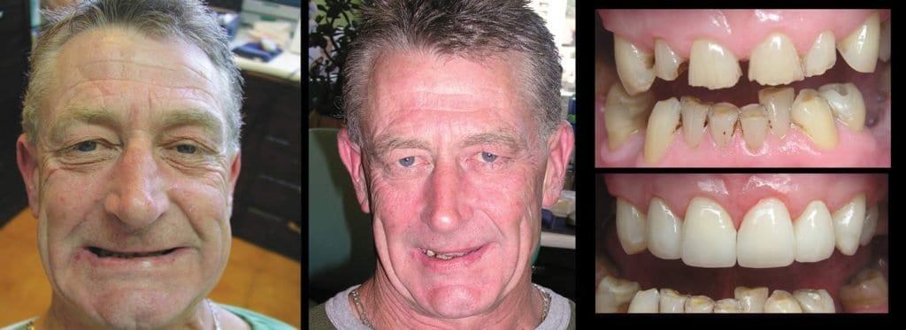 Fixing Short Worn Down Teeth and Small teeth Treatment