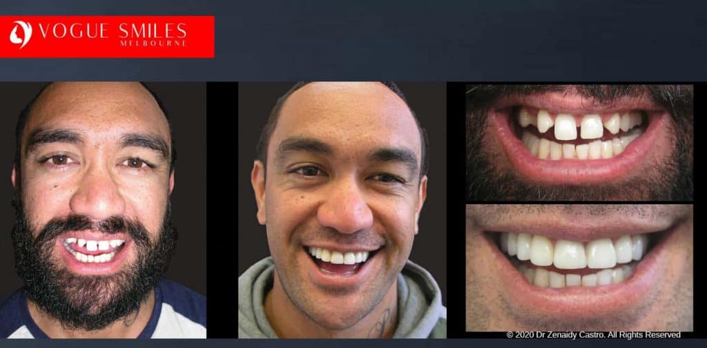 Gappy Teeth Treatment in Melbourne with Porcelain Veneers