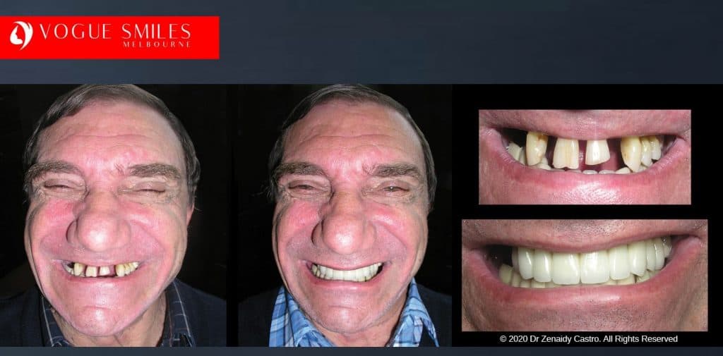 Gappy Teeth Treatment in Melbourne with Porcelain Veneers