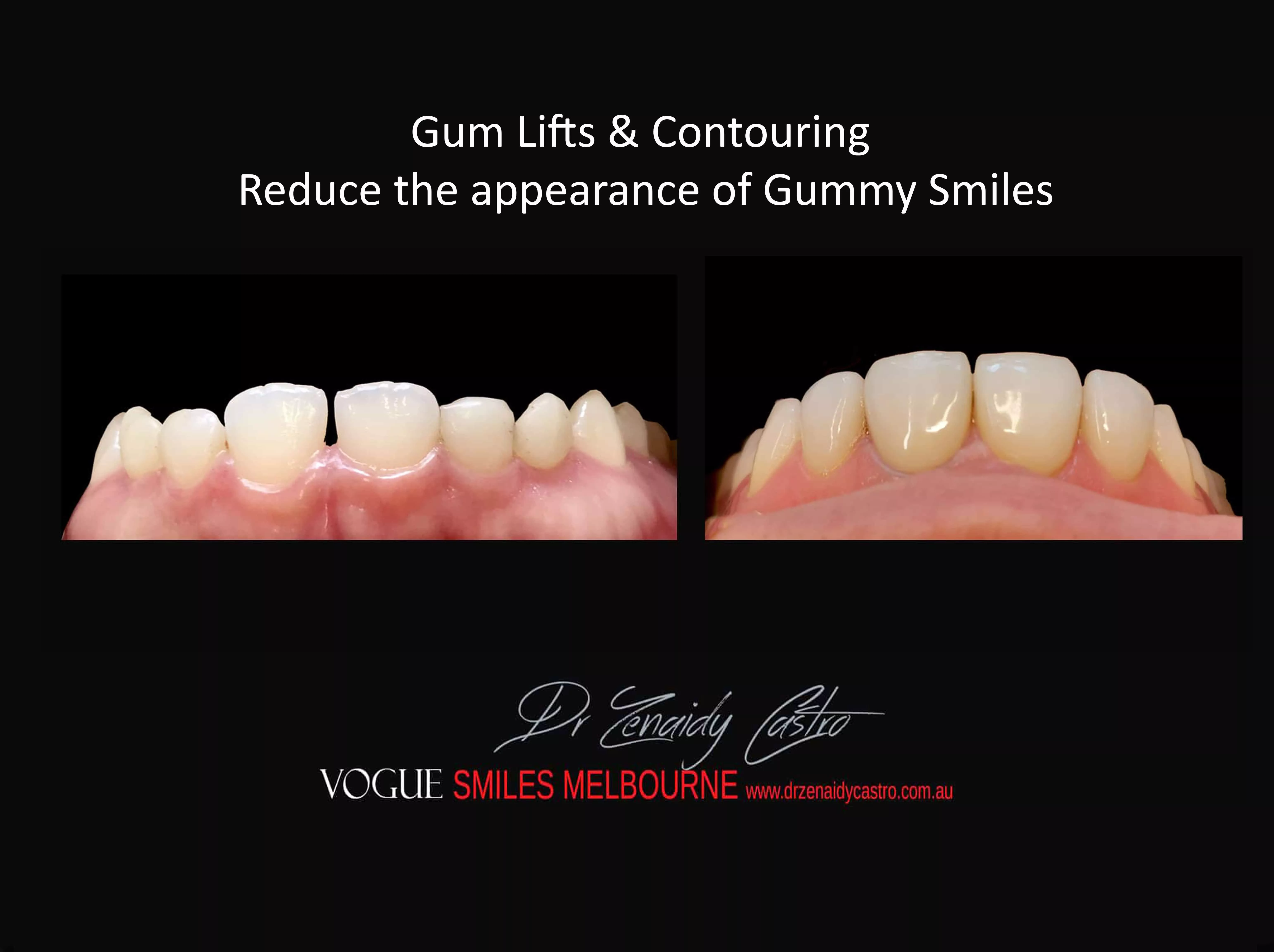 Gum Lifts & Contouring | Reduce Gummy Smiles Melbourne
